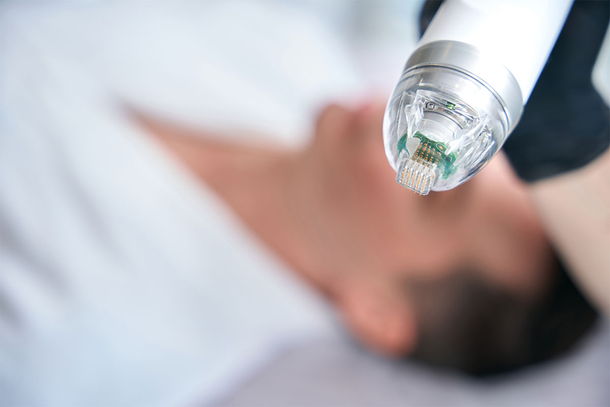 Matrix Pro® RF Microneedling - Morpheus Medical Aesthetics