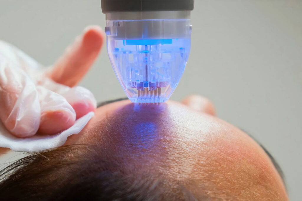Morpheus8 Versus Matrix Pro® | Morpheus Medical Aesthetics